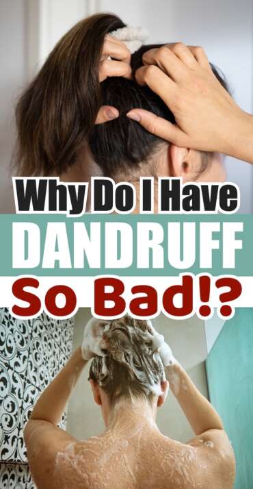 Why Do I Have Dandruff So Bad?