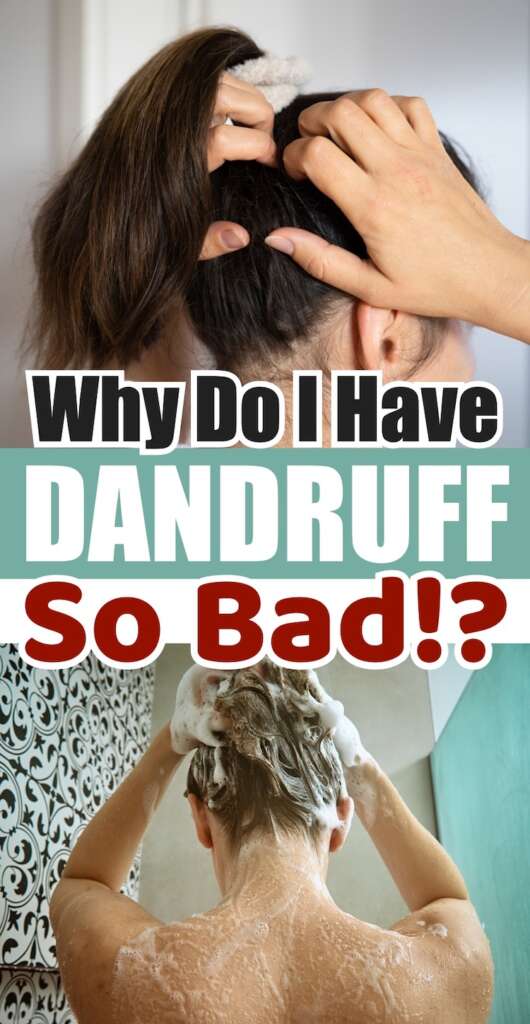 Why Do I Have Dandruff So Bad?